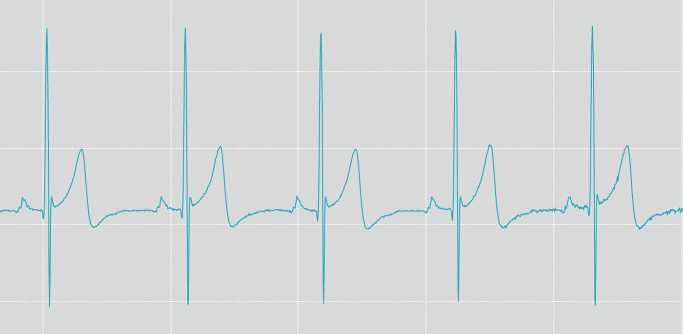 The ECG - everything you need to know!